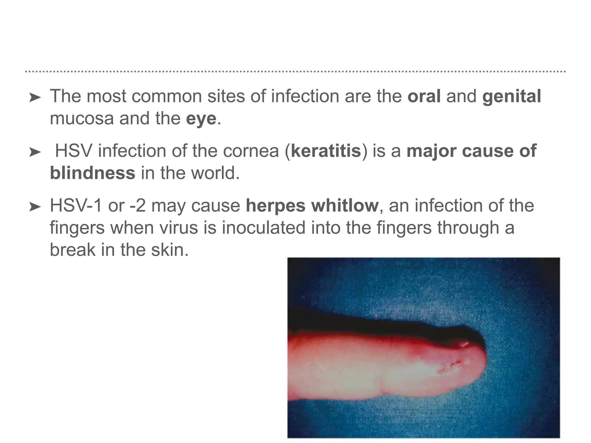 Herpes simplex in oral cavity | PPT