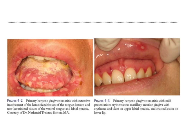 Herpes simplex in oral cavity | PPT | Dental Health | Diseases and ...