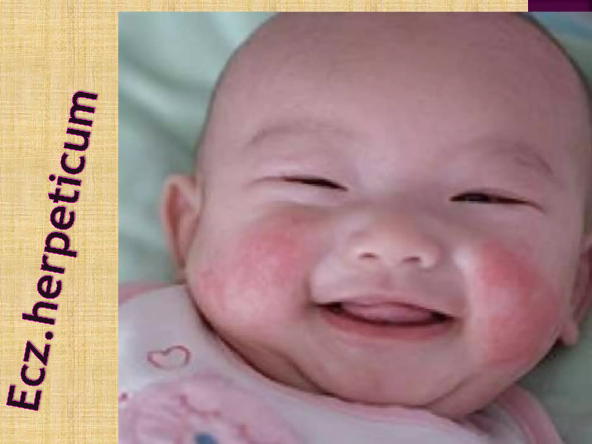 Herpes simlex virus | PPTX