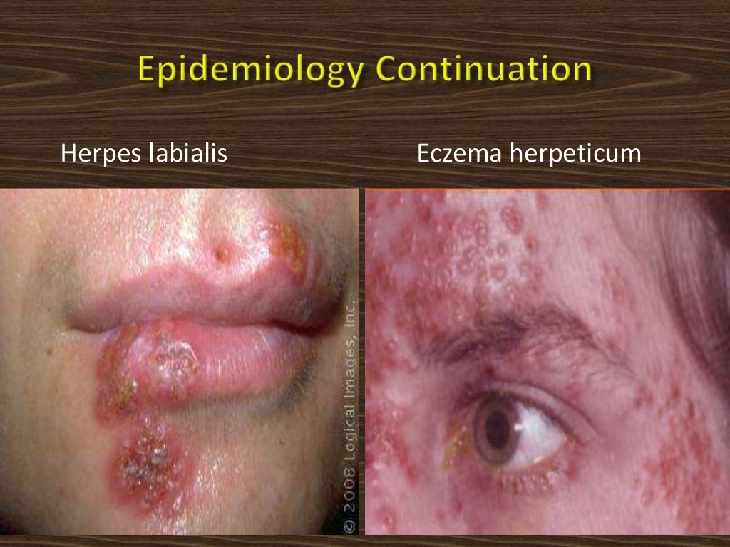 Herpes Simples viral encephalitis by aminu arzet