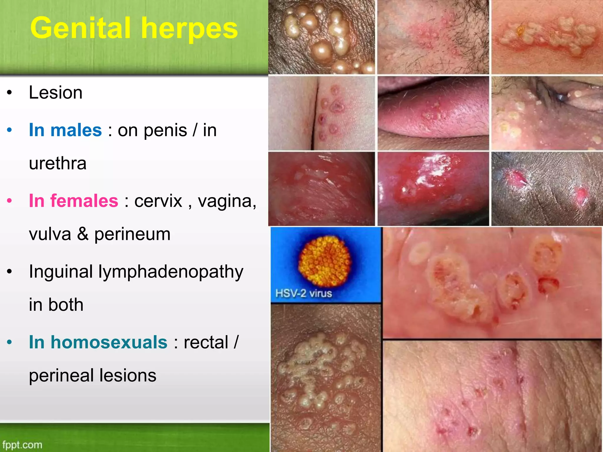 Herpes Virus and Varicella | PPT