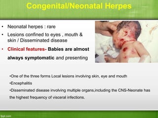 Herpes Virus and Varicella | PPT