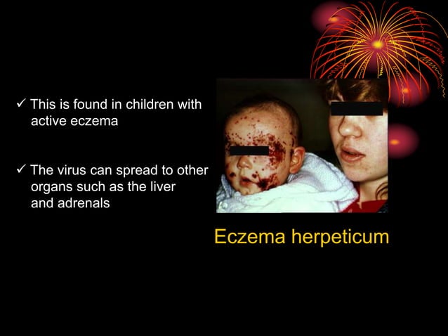 herpesviruses bacteria virus and infection | PPT