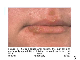 Biochemistry of herpes viruses | PPT