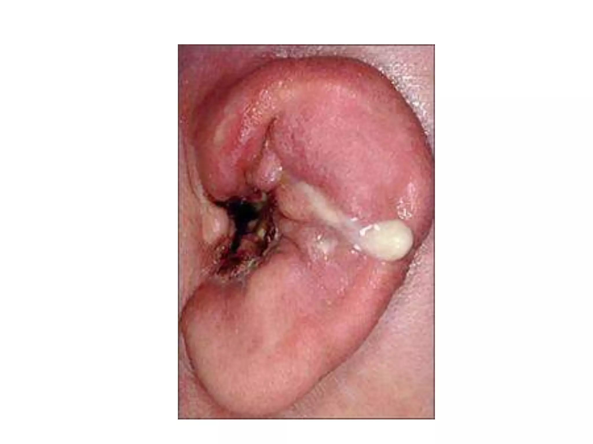 Herpes zoster by dr bashir ahmed dar associate professor medicine sopore kashmir | PPT