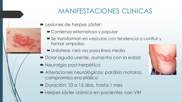 Herpes zoster