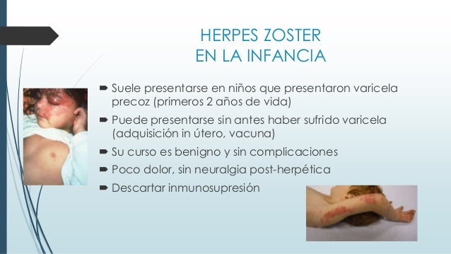 Herpes zoster