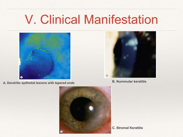 Herpes Zoster Ophthalmicus | PPTX | Eye and Vision Conditions ...