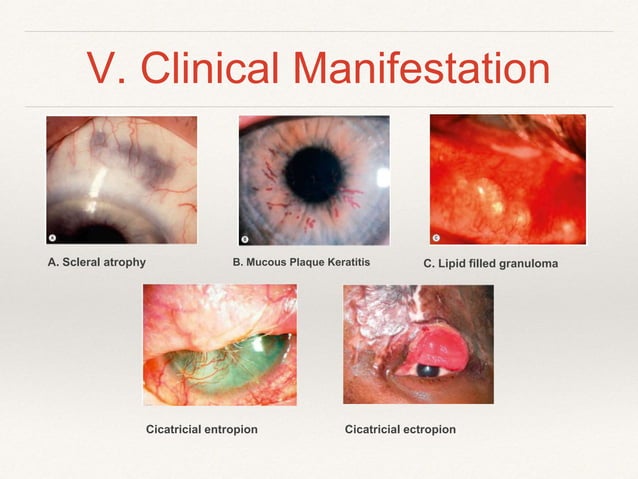 Herpes Zoster Ophthalmicus | PPTX | Eye and Vision Conditions ...