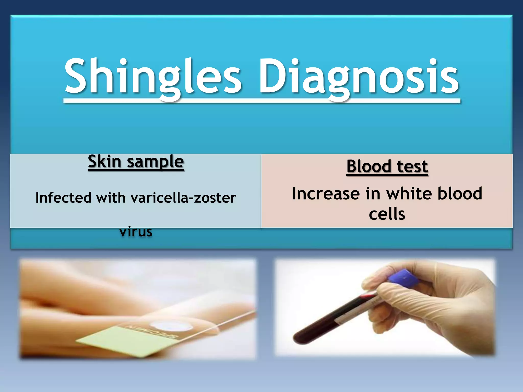 Herpes zoster | PPTX