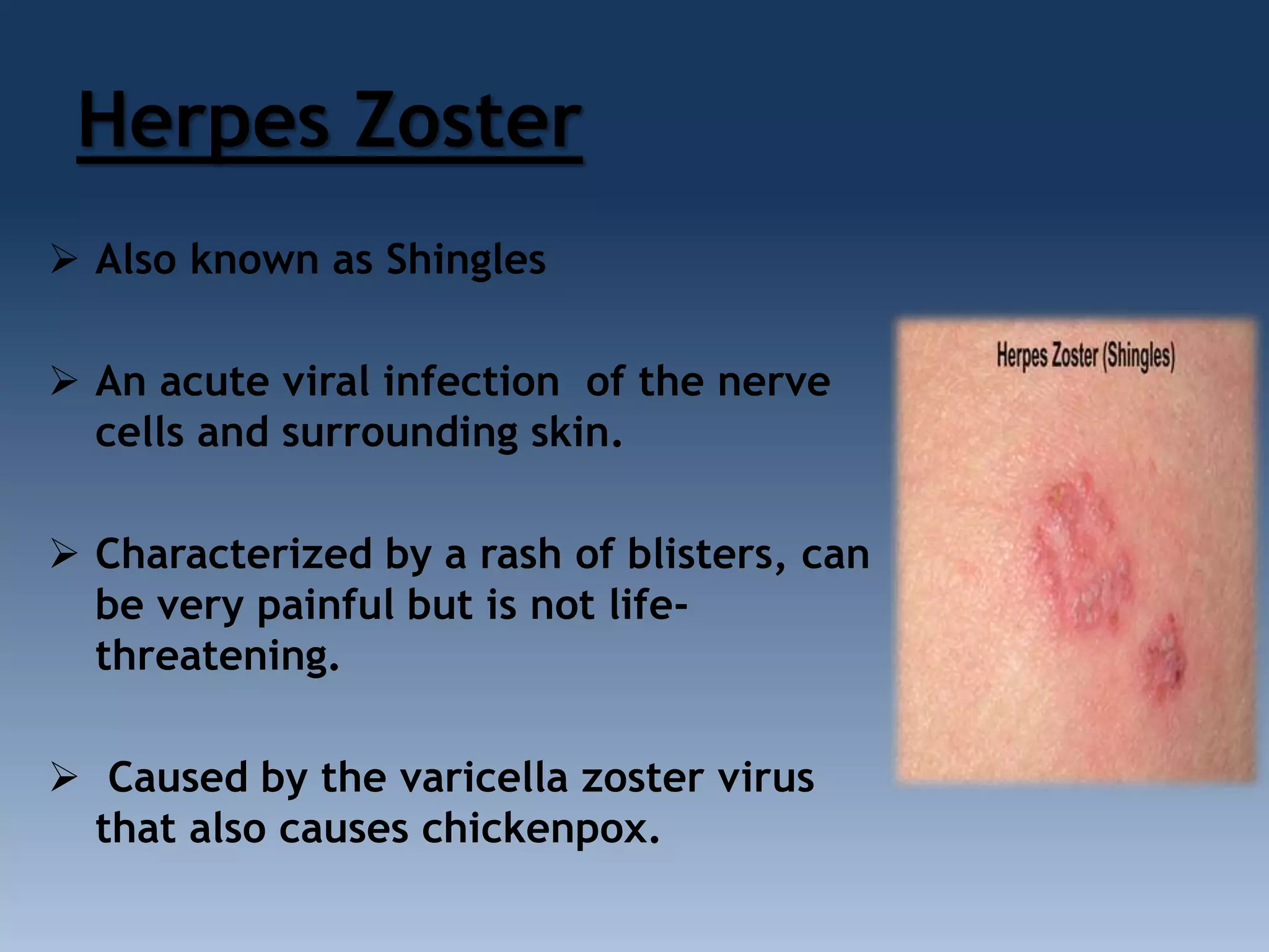 Herpes Zoster Virus Pictures