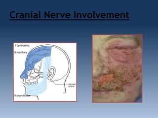 Herpes zoster | PPTX