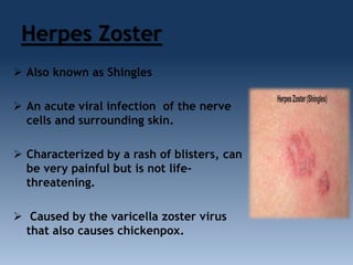 Herpes Zoster Vs Herpes Simplex