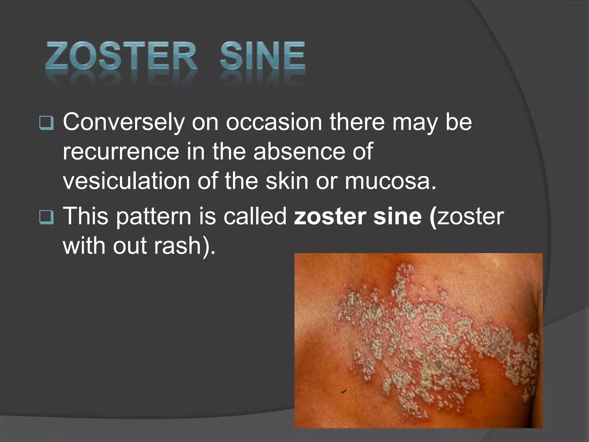 Herpes zoster | PPTX
