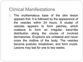 Herpes Zoster (Shigella) NCM 104 | PPTX