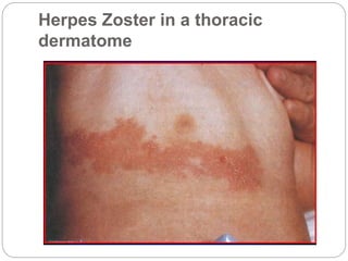 Herpes Zoster (Shigella) NCM 104 | PPTX