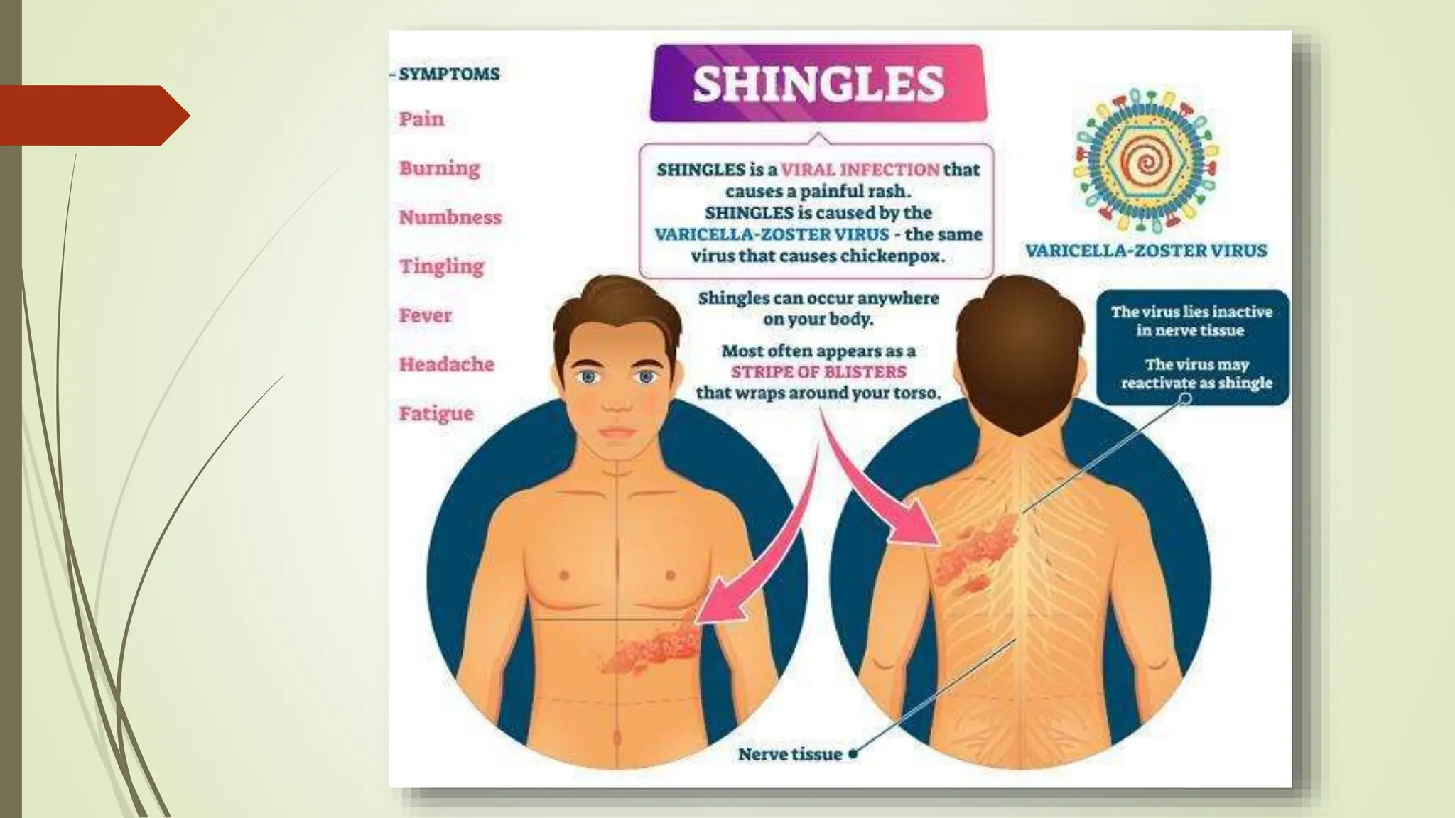 Herpes Zoster Shingles Pptx