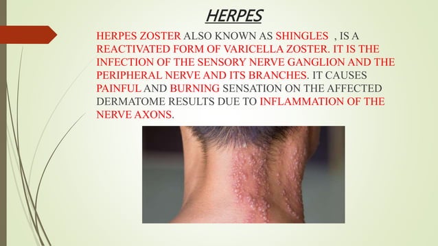 HERPES ZOSTER (shingles) | PPTX