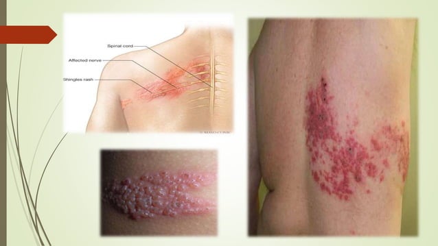 HERPES ZOSTER (shingles) | PPTX