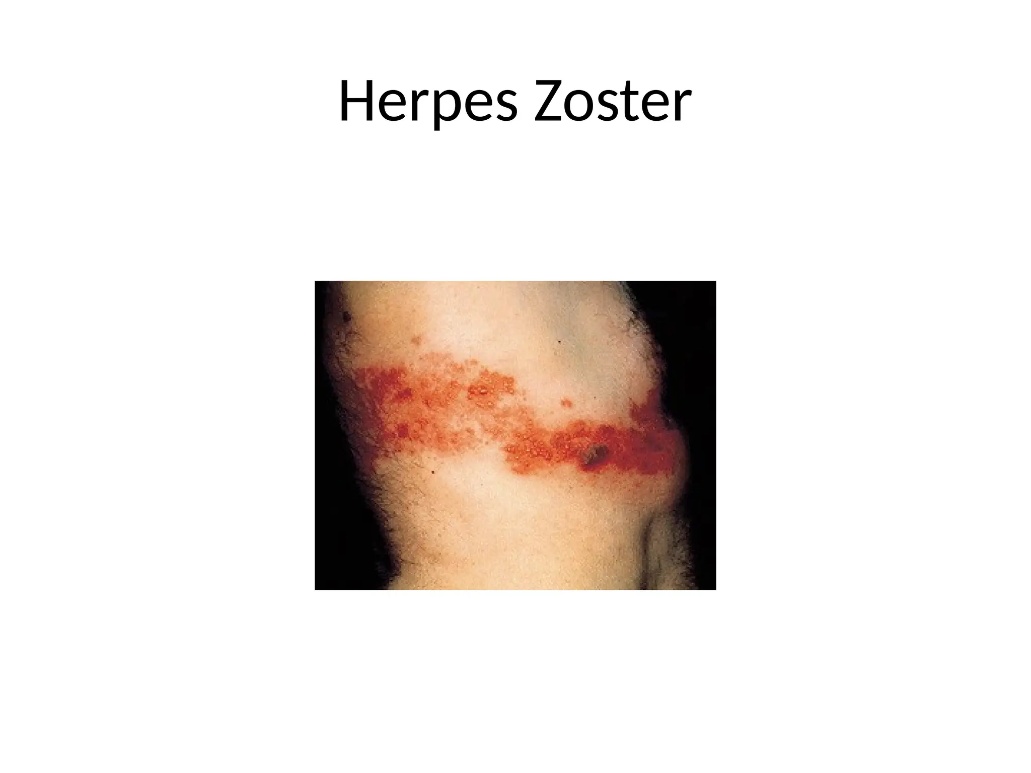 Herpes zoster , causes , manifestation and treatment. nd | PPTX