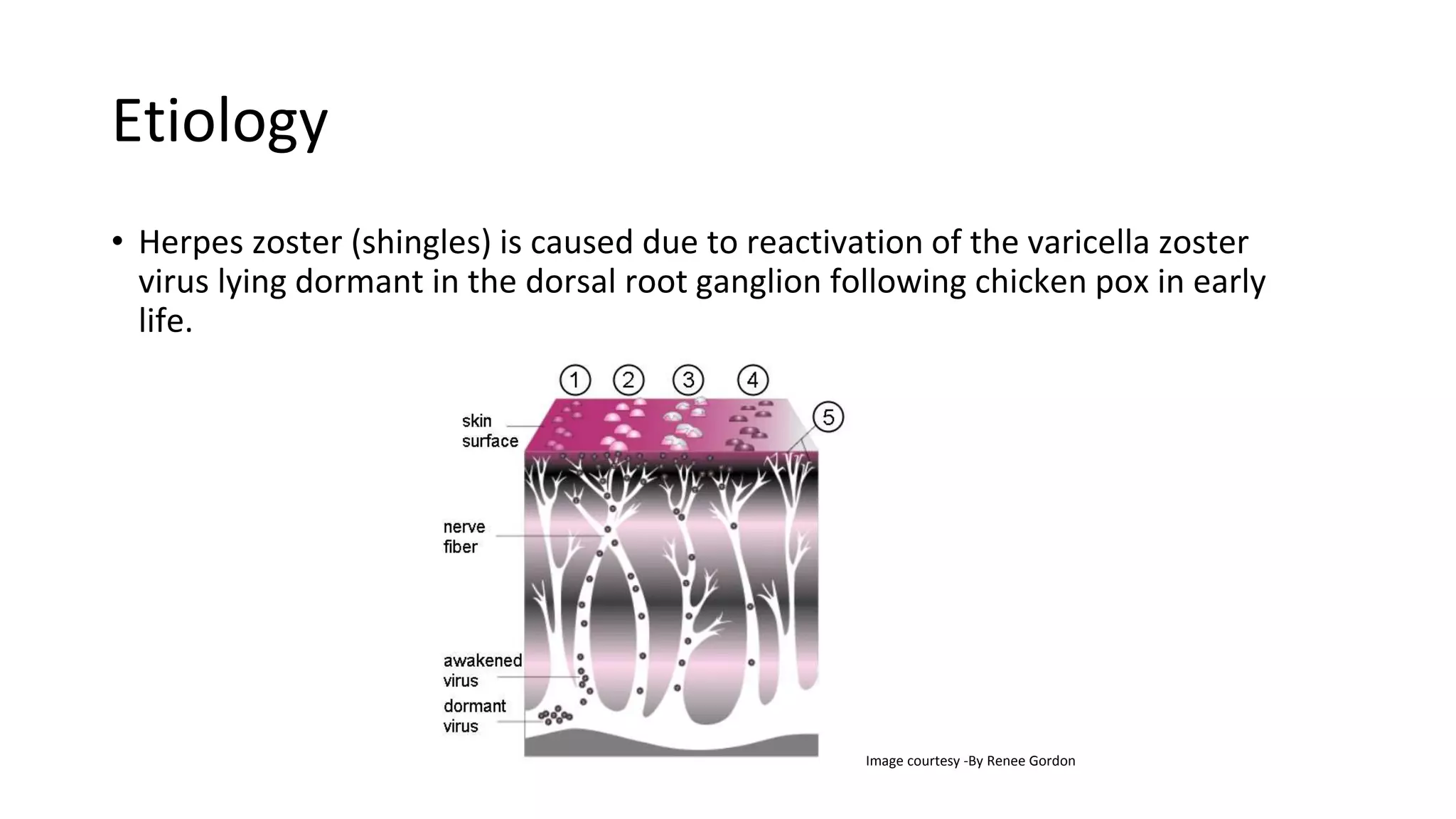 Herpes zoster shingles and chickenpox | PPTX