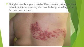 Herpes zoster 2.0.pptx healthcare . ayurveda for life | PPTX