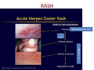 Herpes zoster and phn (1) | PPTX