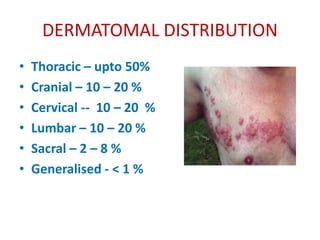 Herpes zoster and phn (1) | PPTX