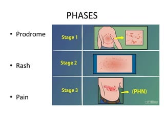 Herpes zoster and phn (1) | PPT