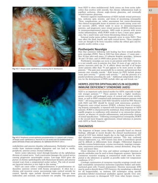 Herpes zoster ophthalmicus | PDF