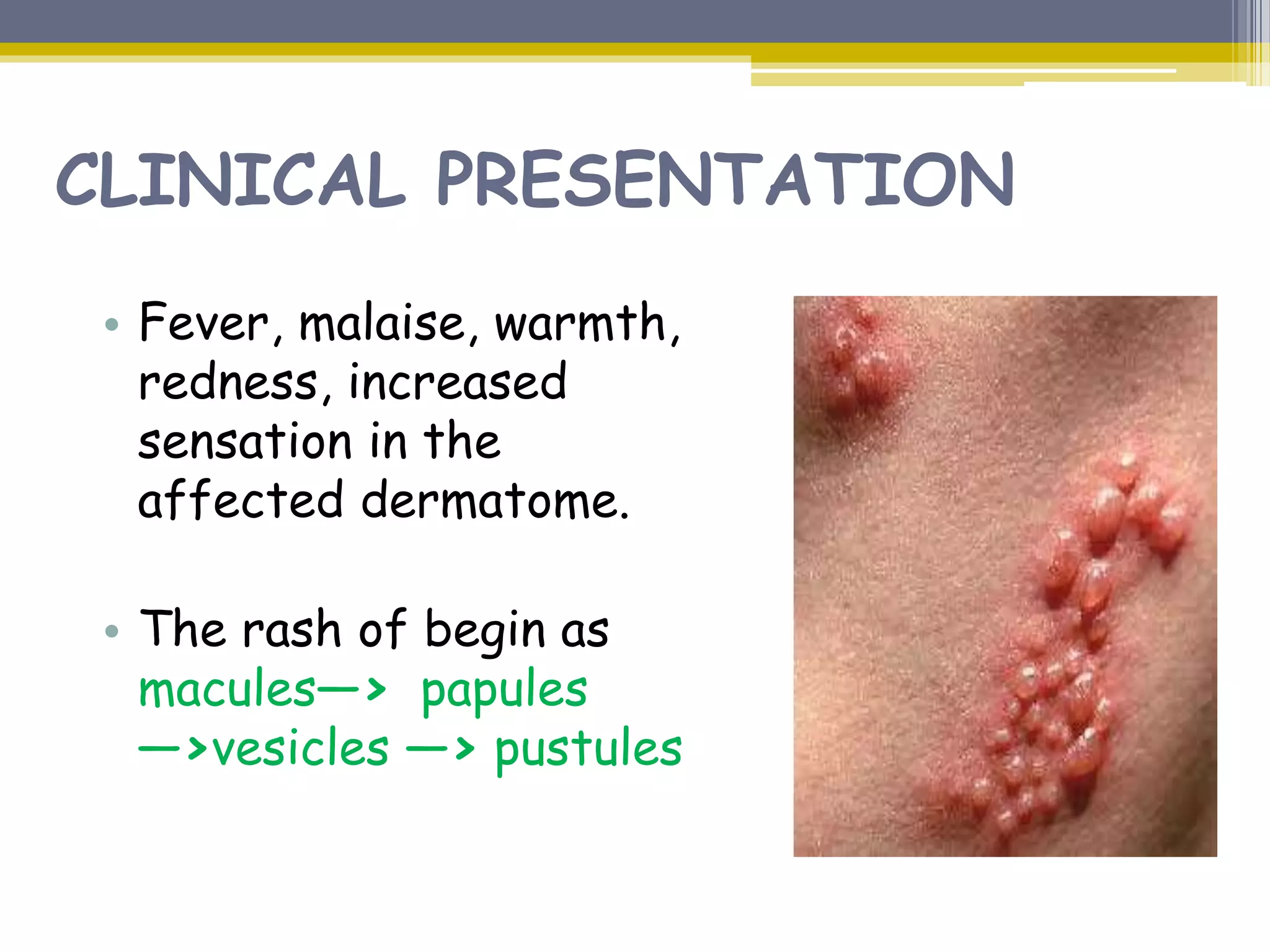 Herpes zoster ophthalmicus | PPTX