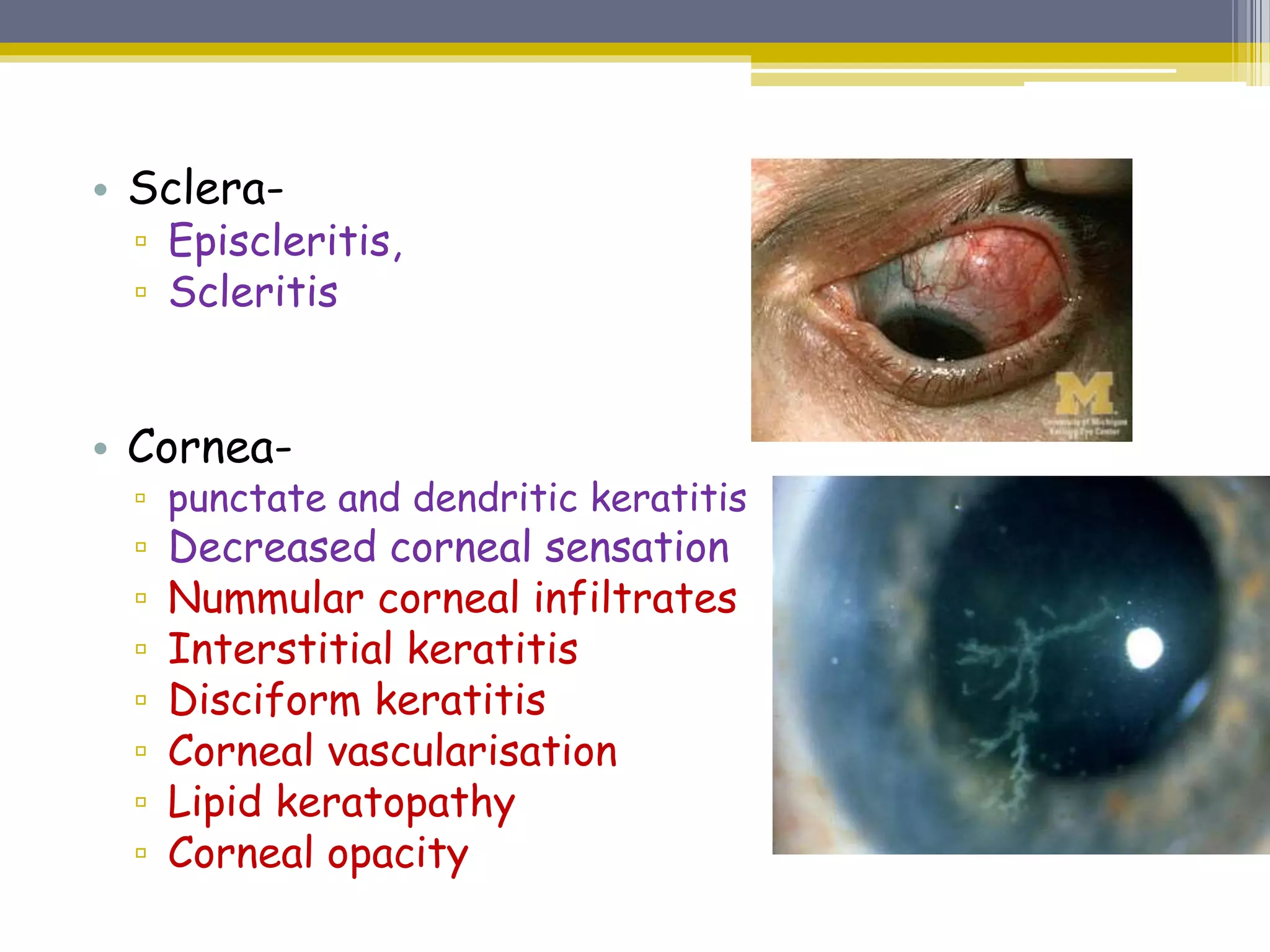 Herpes zoster ophthalmicus | PPTX