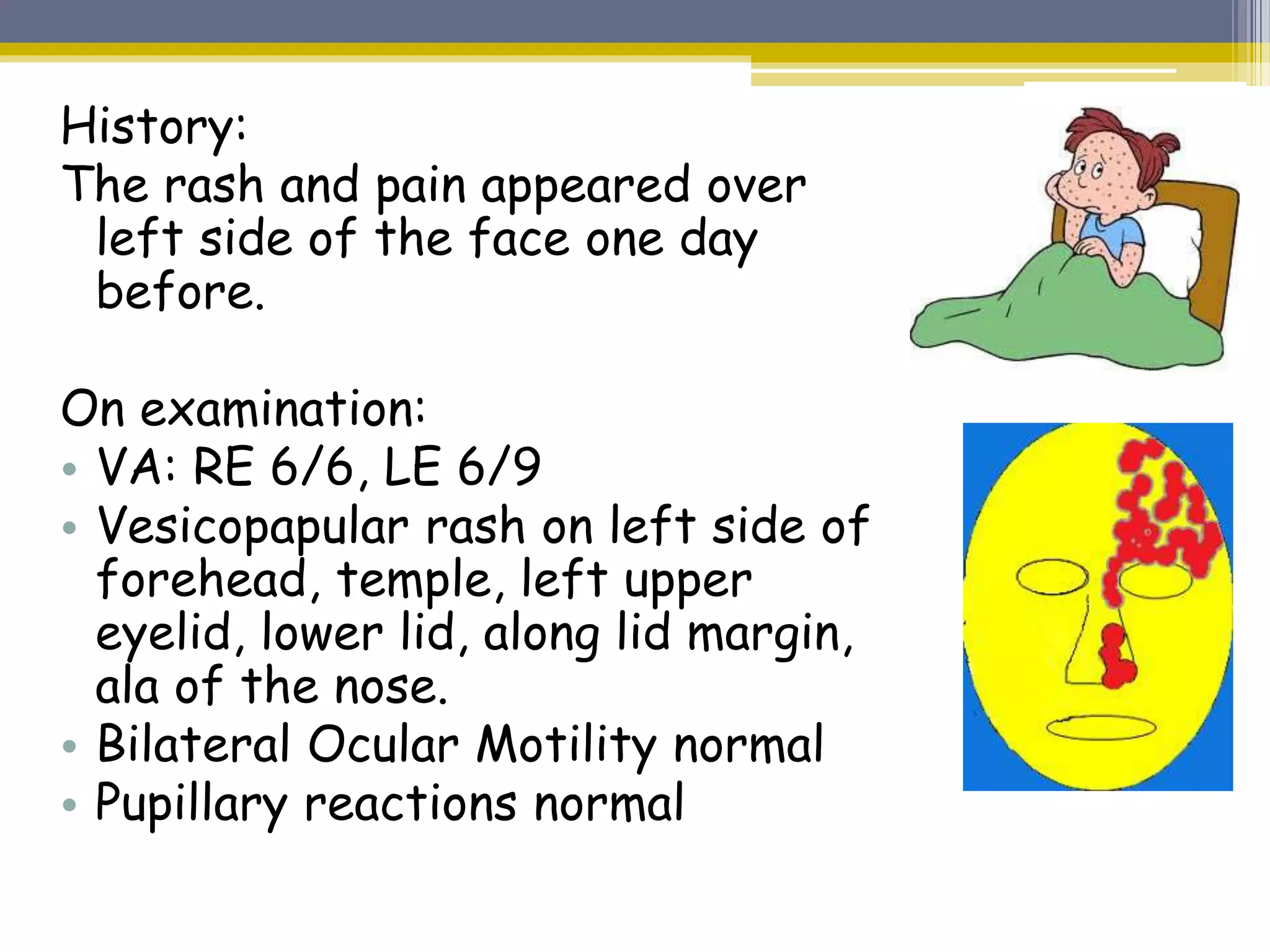 Herpes zoster ophthalmicus | PPTX