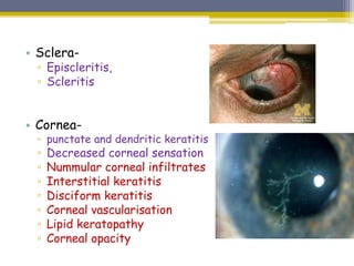 Herpes zoster ophthalmicus | PPTX