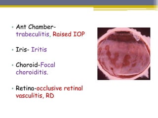Herpes zoster ophthalmicus | PPTX