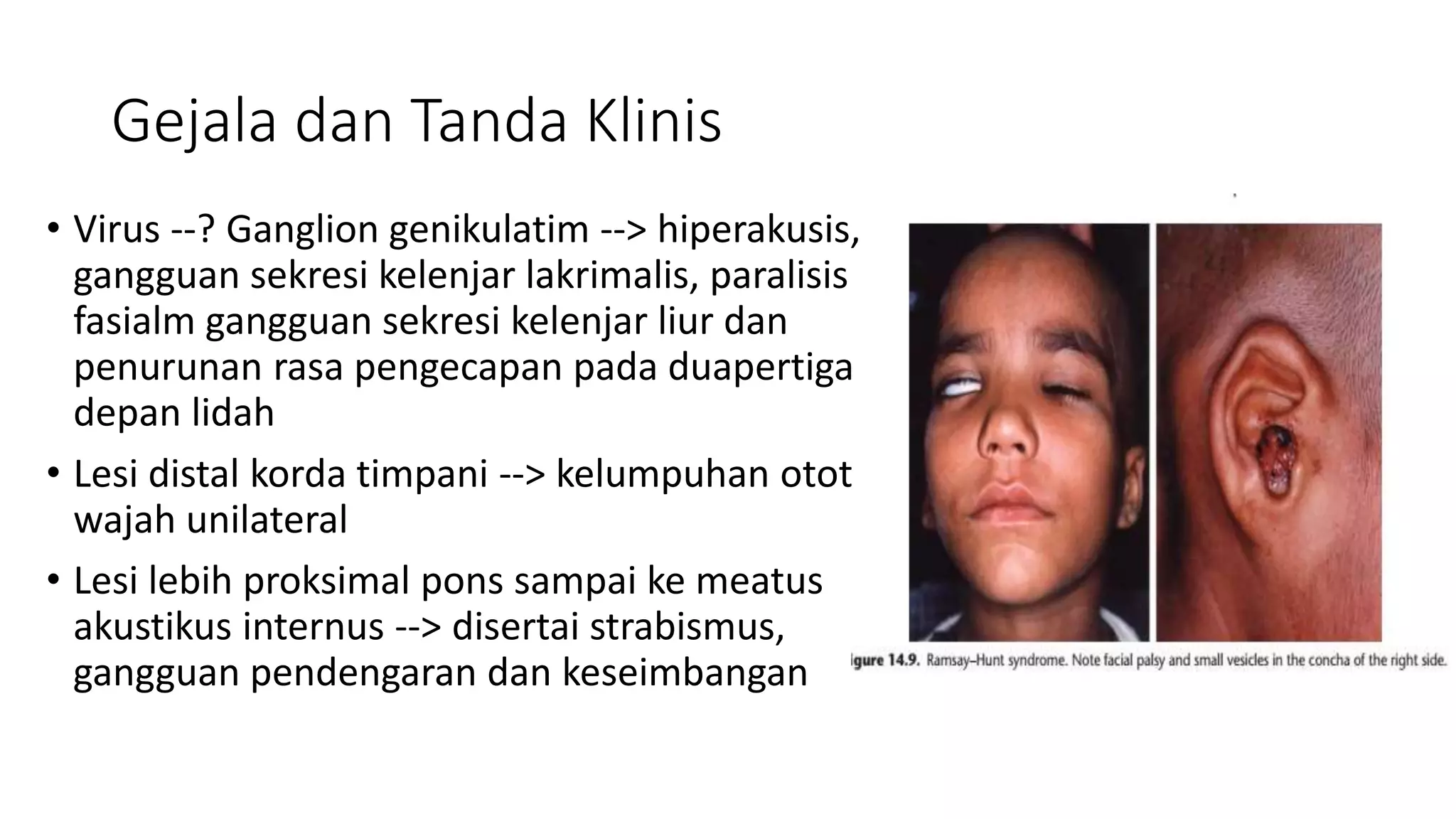 Herpes zoster oticus | PPT