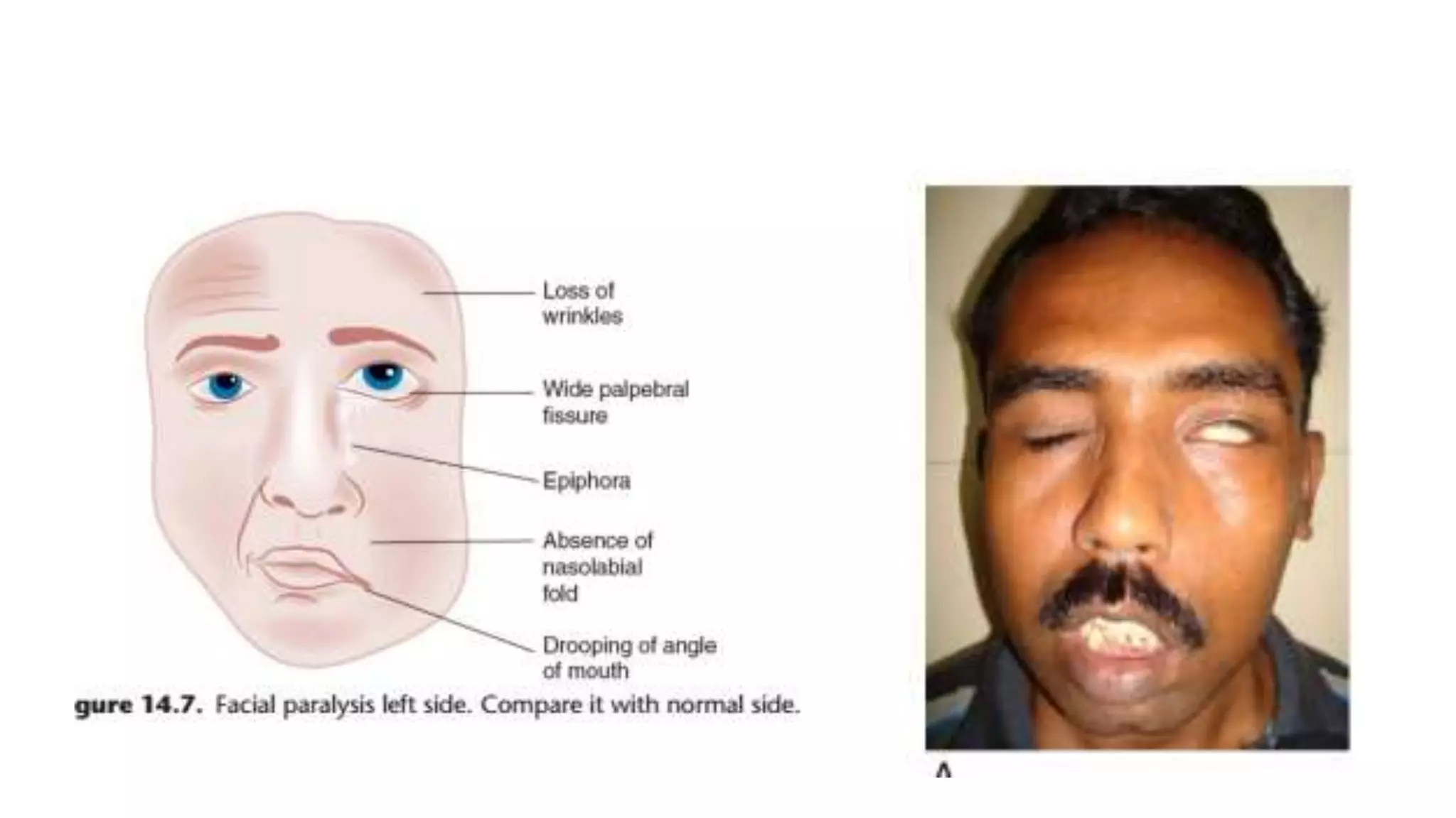 Herpes zoster oticus | PPT