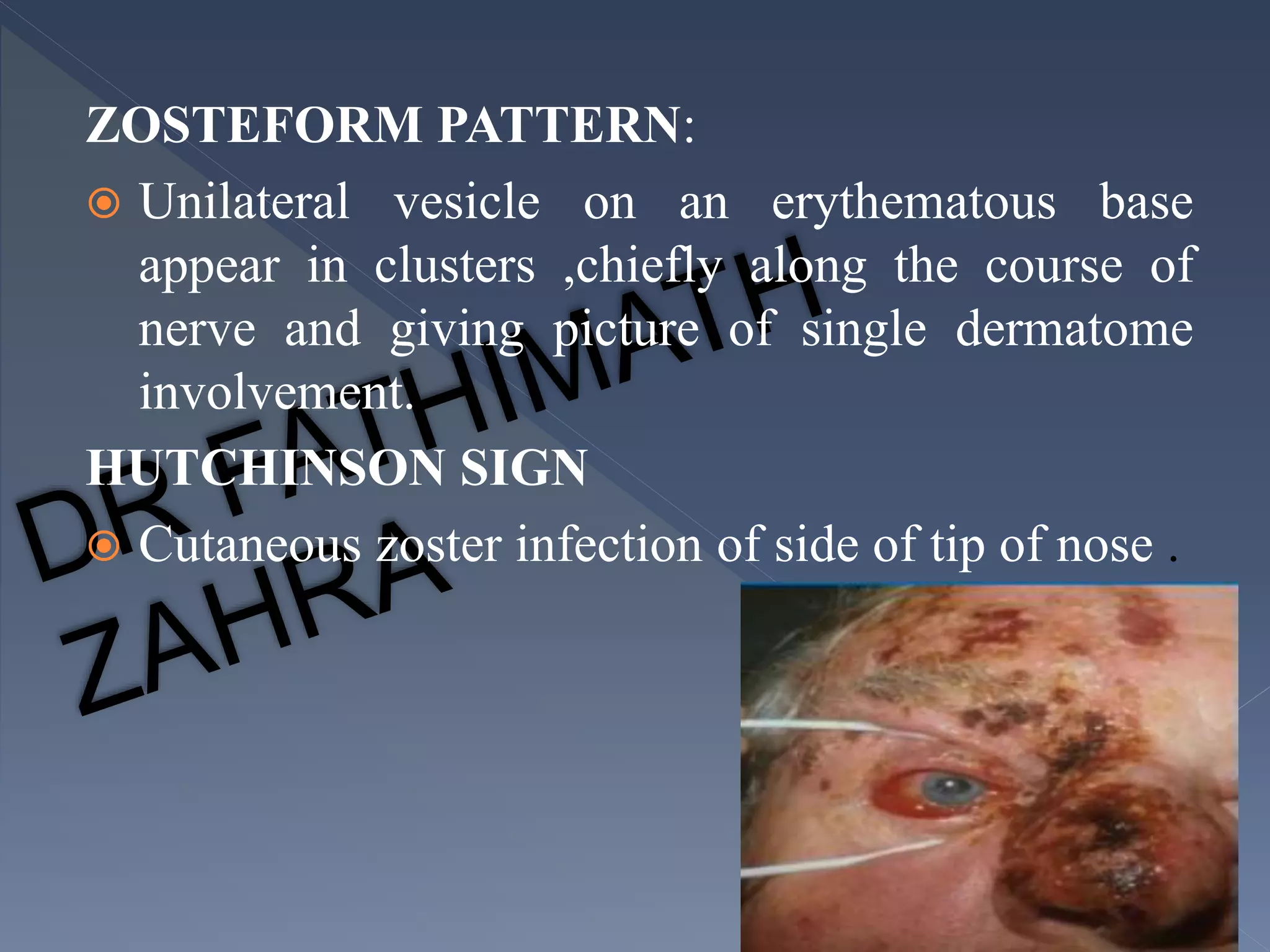 Herpes zoster ppt | PPTX