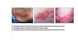 Laporan kasus HERPES ZOSTER di PKM. pptx | PPTX