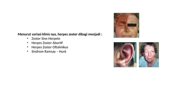 Laporan kasus HERPES ZOSTER di PKM. pptx | PPTX