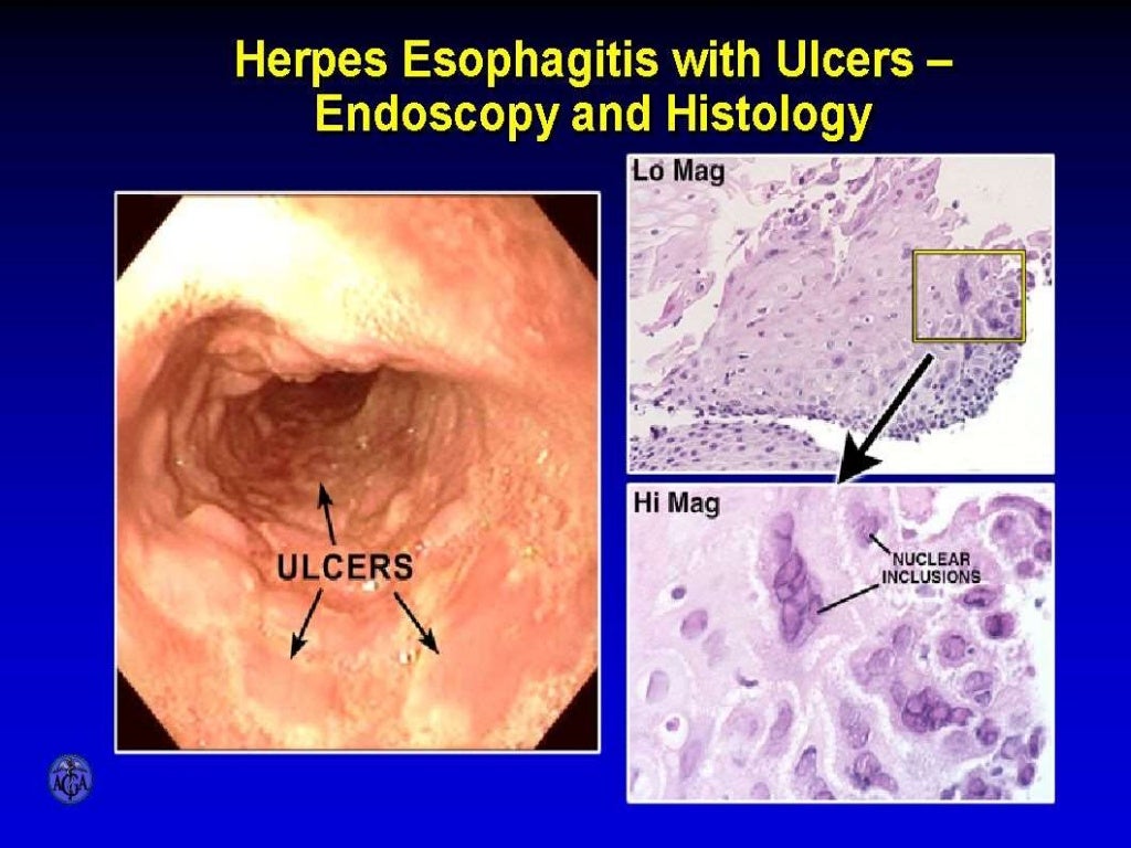 Herpetic esophagitis