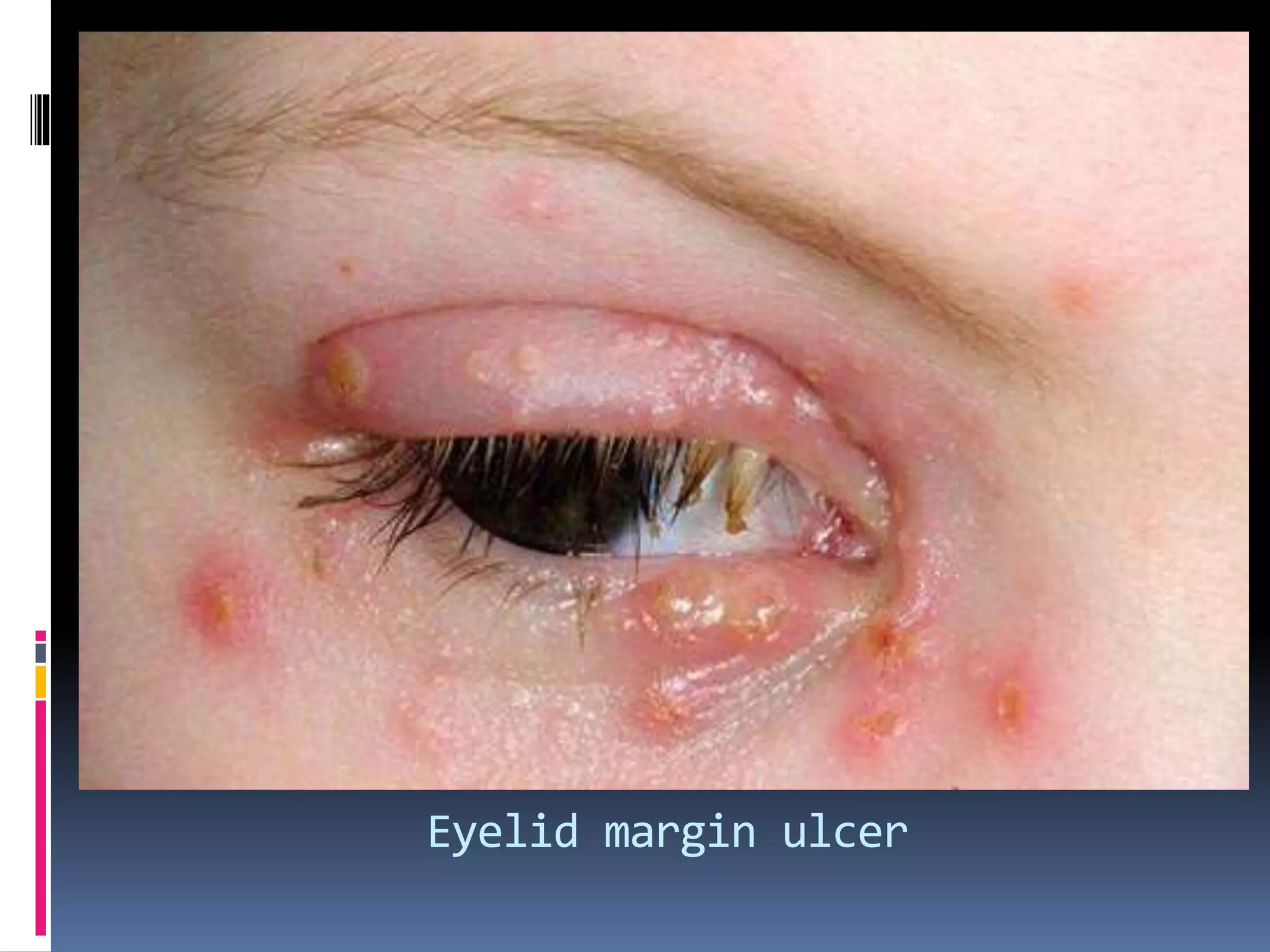 herpes simplex ocular diseases | PPTX