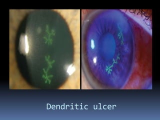 herpes simplex ocular diseases | PPTX