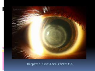 Disciform Keratitis