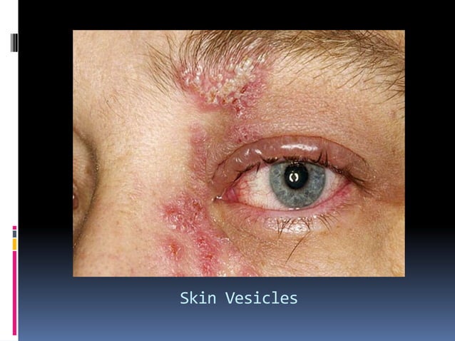herpes simplex ocular diseases | PPT