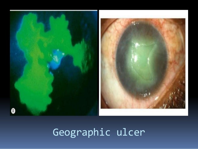 Herpetic Epithelial Keratitis Eyes And Vision Specialist Herpes