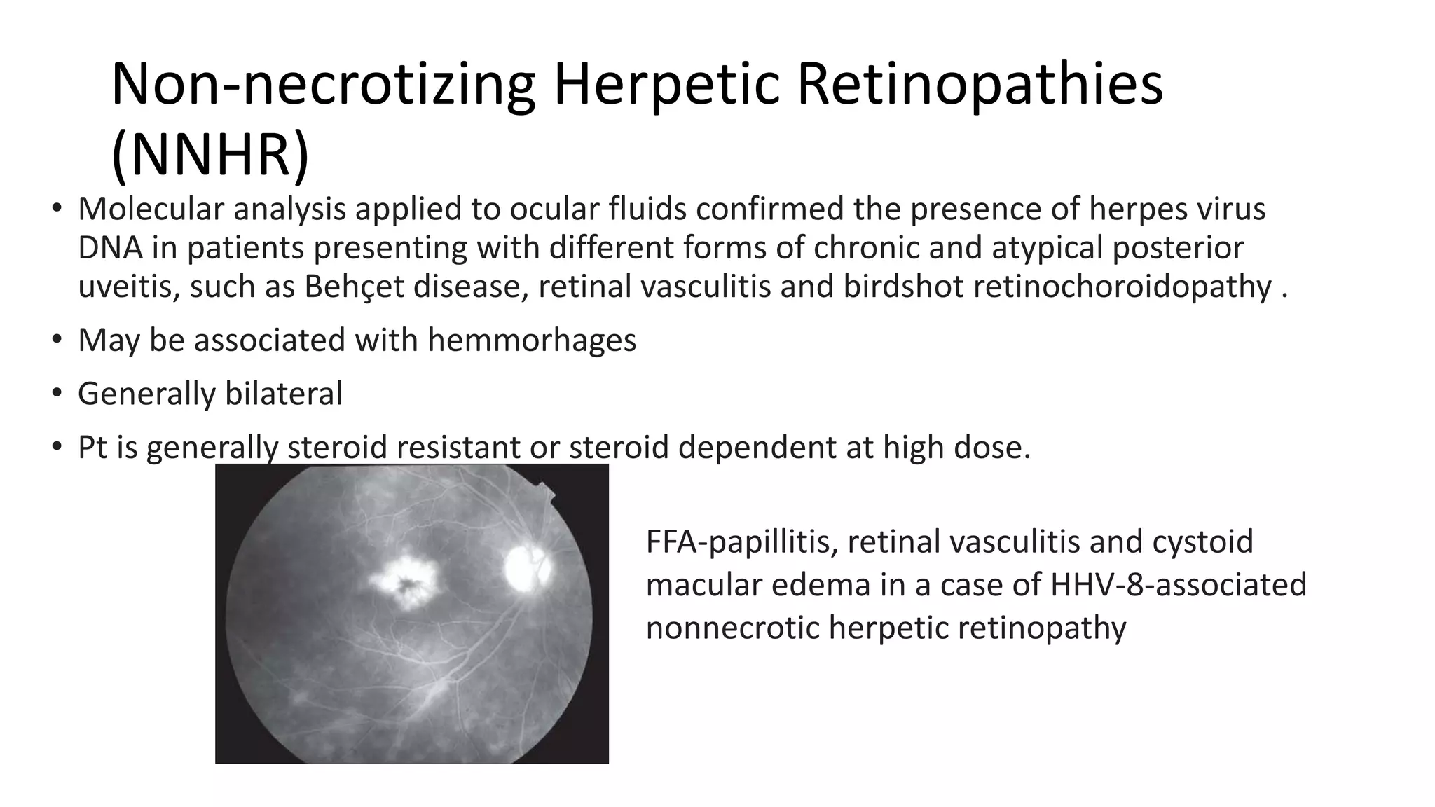 Herpetic viral retinitis | PPTX | Eye and Vision Conditions | Diseases ...