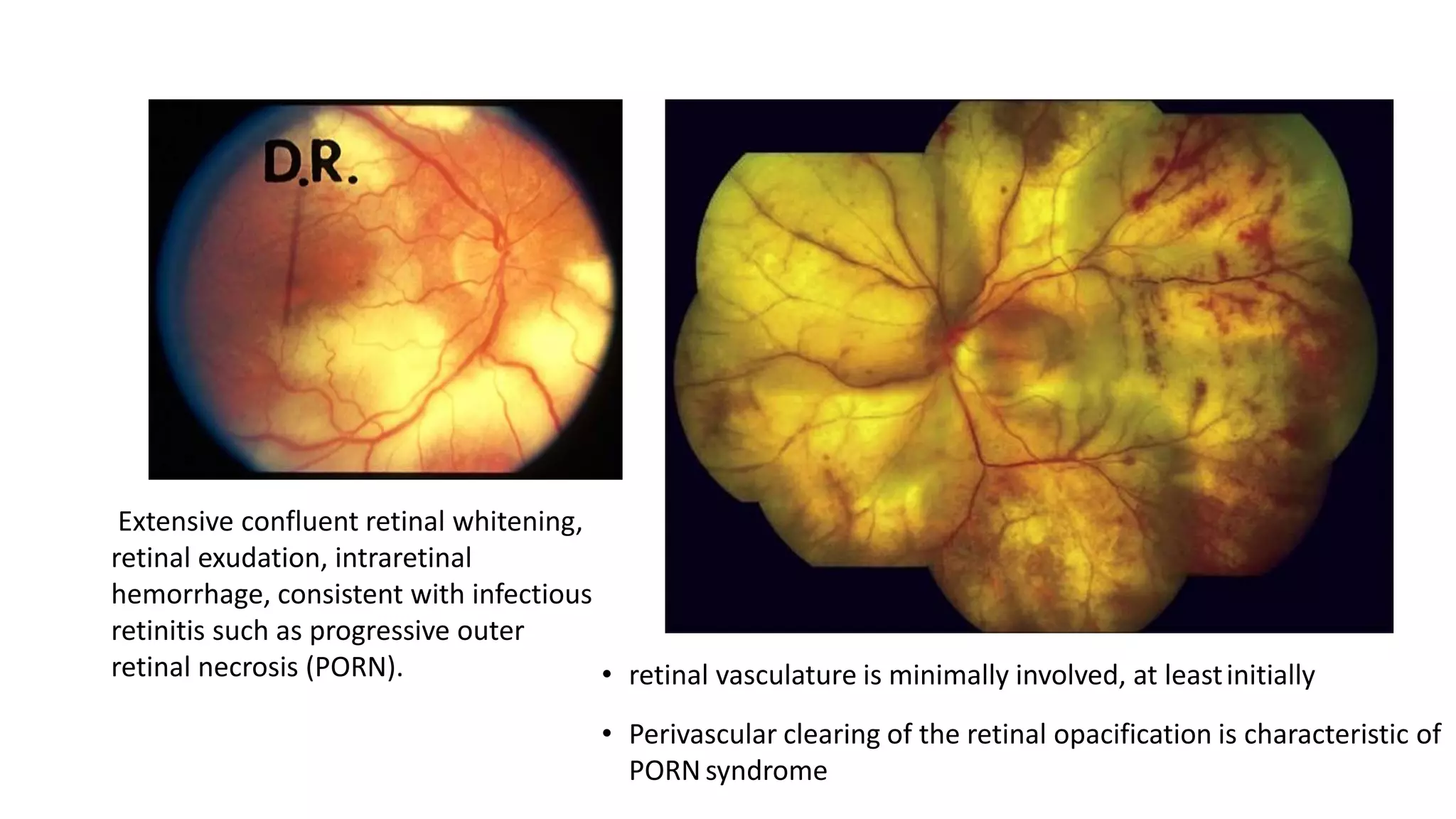 Herpetic viral retinitis | PPTX | Eye and Vision Conditions | Diseases ...