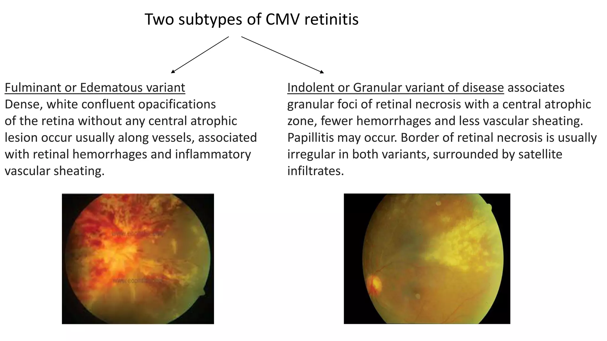 Herpetic viral retinitis | PPTX | Eye and Vision Conditions | Diseases ...