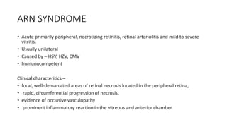 Herpetic viral retinitis | PPTX | Eye and Vision Conditions | Diseases ...